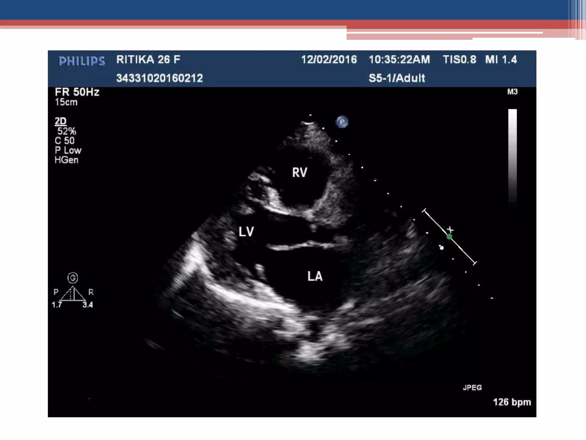 LEFT VENTRICULAR NON COMPACTION (LVNC) | PPTX | Heart and ...