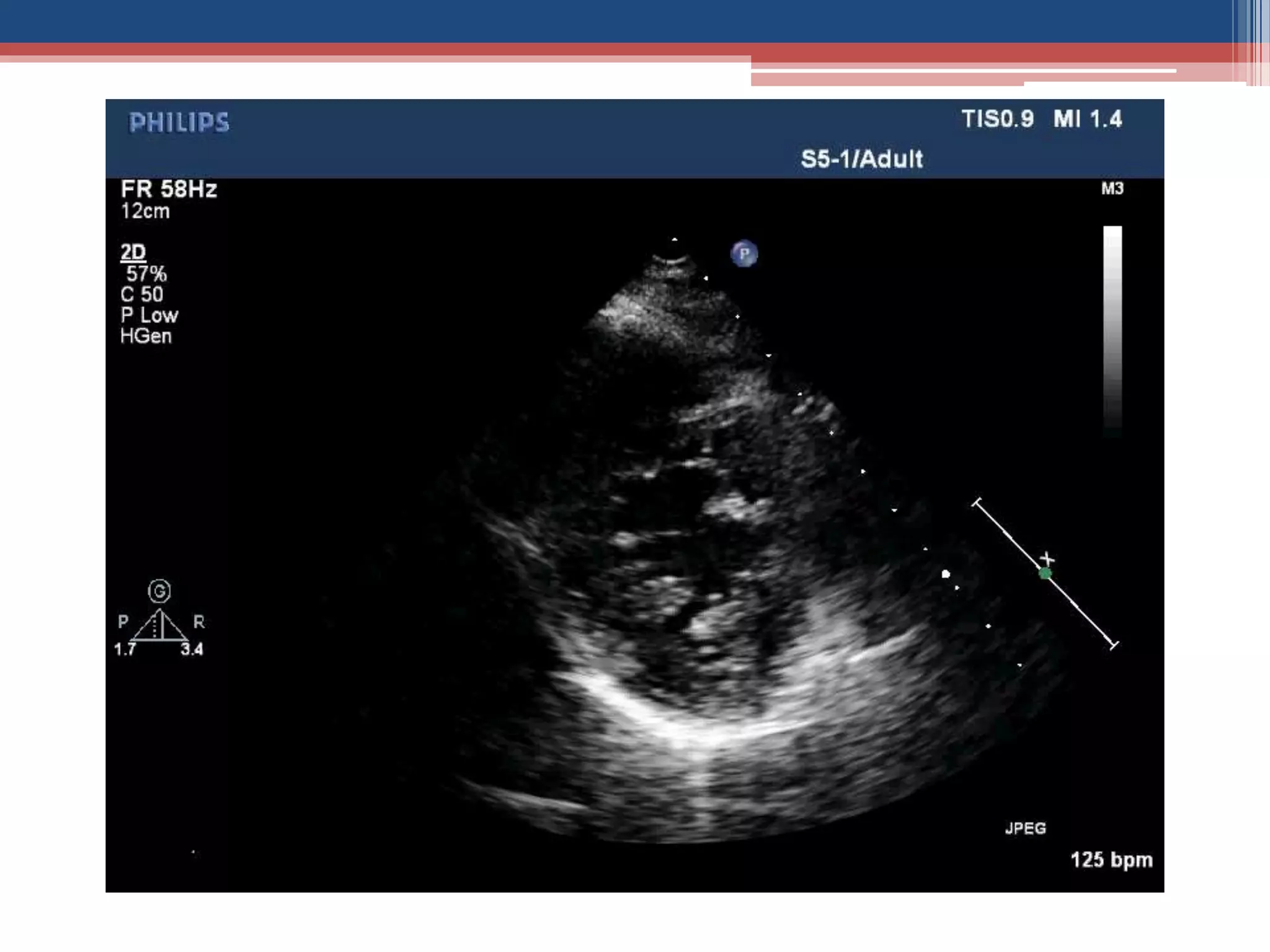 LEFT VENTRICULAR NON COMPACTION (LVNC) | PPTX