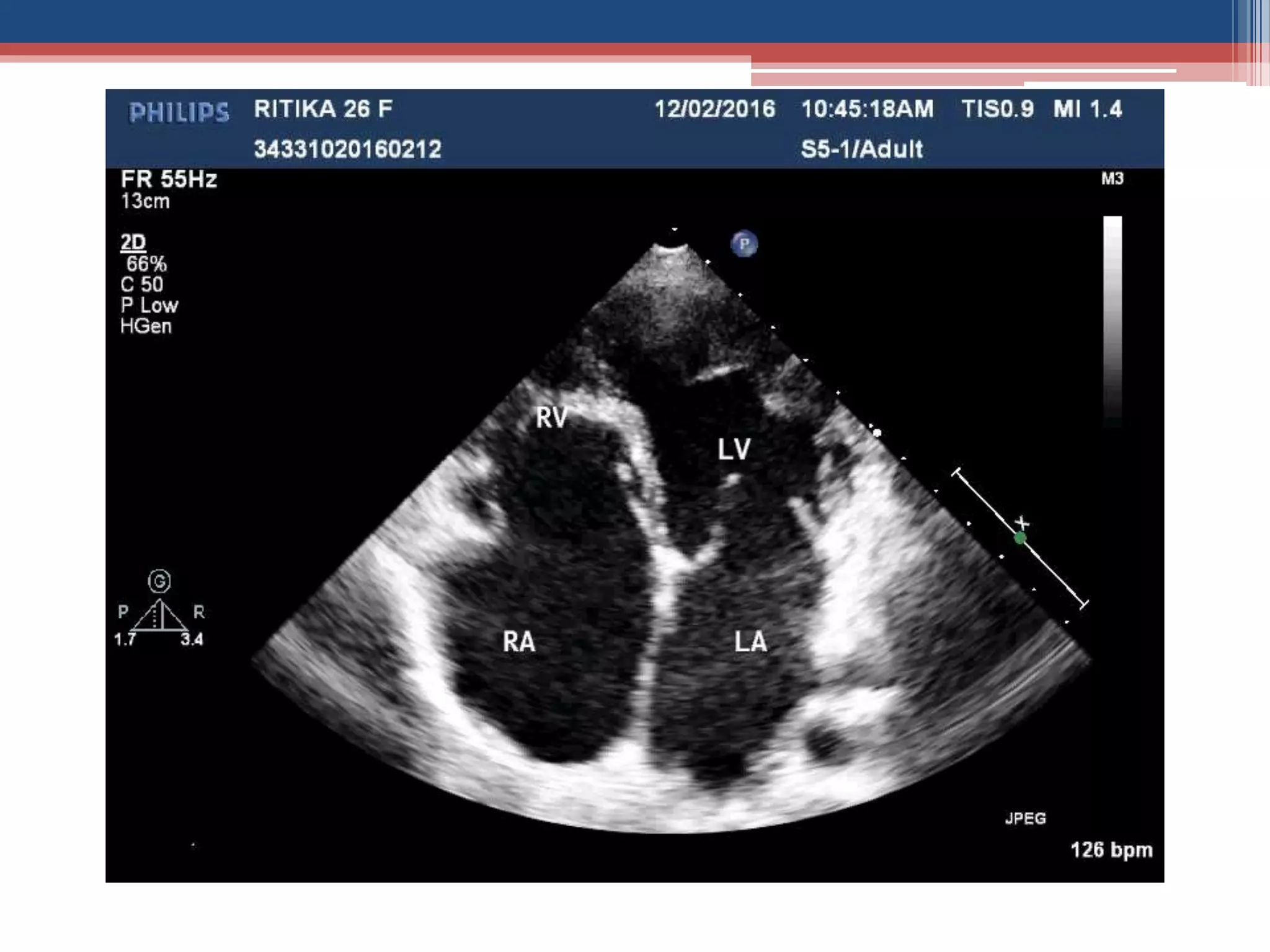 LEFT VENTRICULAR NON COMPACTION (LVNC) | PPTX | Heart and ...