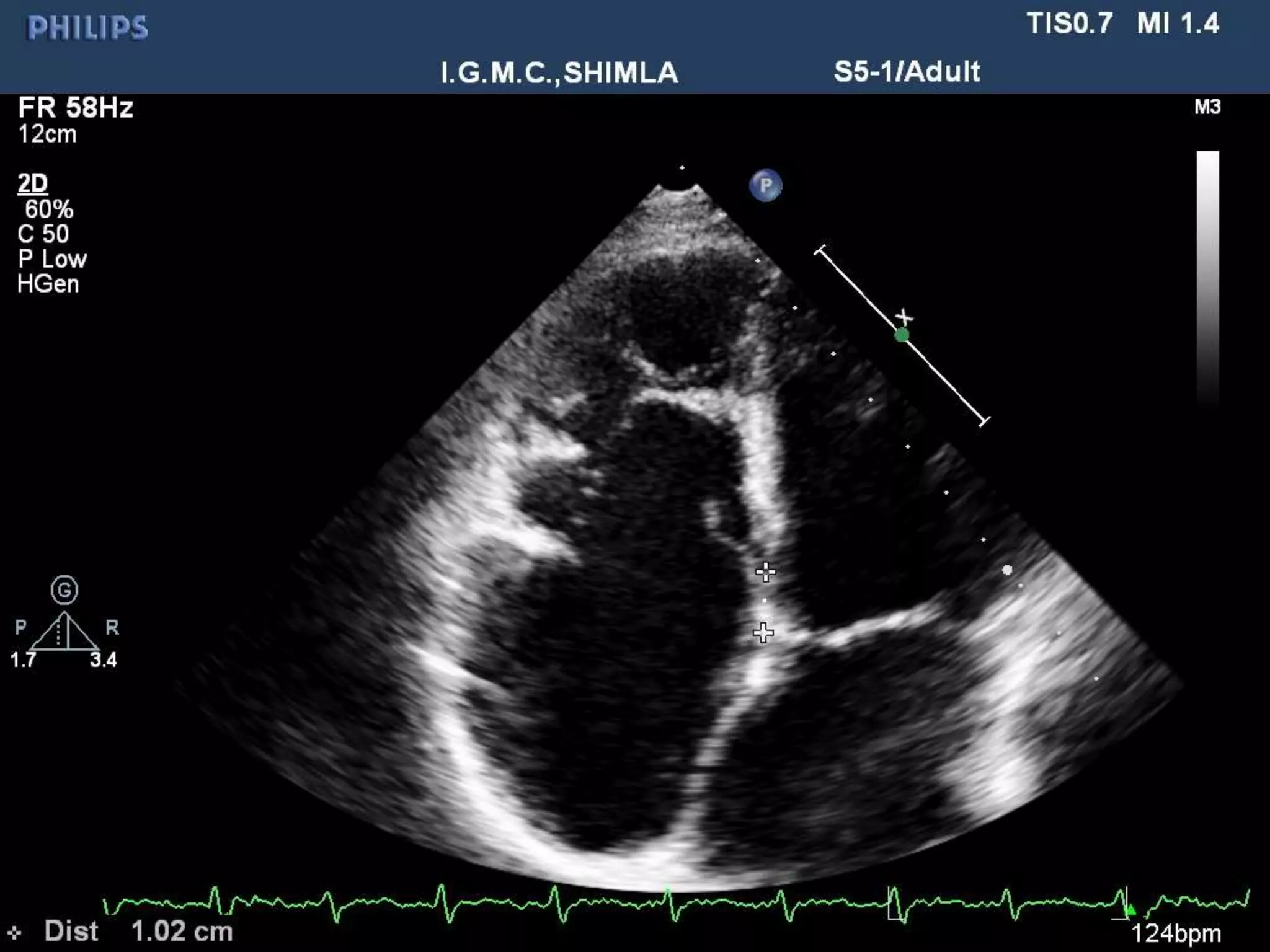LEFT VENTRICULAR NON COMPACTION (LVNC) | PPTX