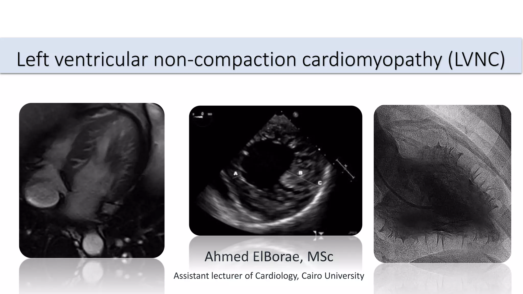 LV non-compaction cardiomyopathy | PDF | Heart and Cardiovascular ...