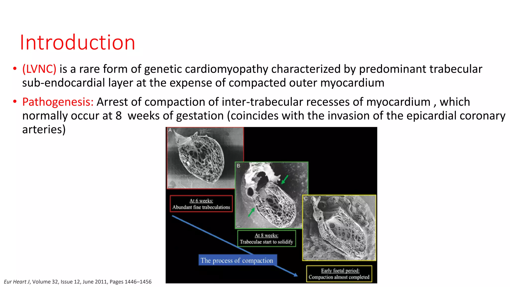 LV non-compaction cardiomyopathy | PDF | Heart and Cardiovascular ...