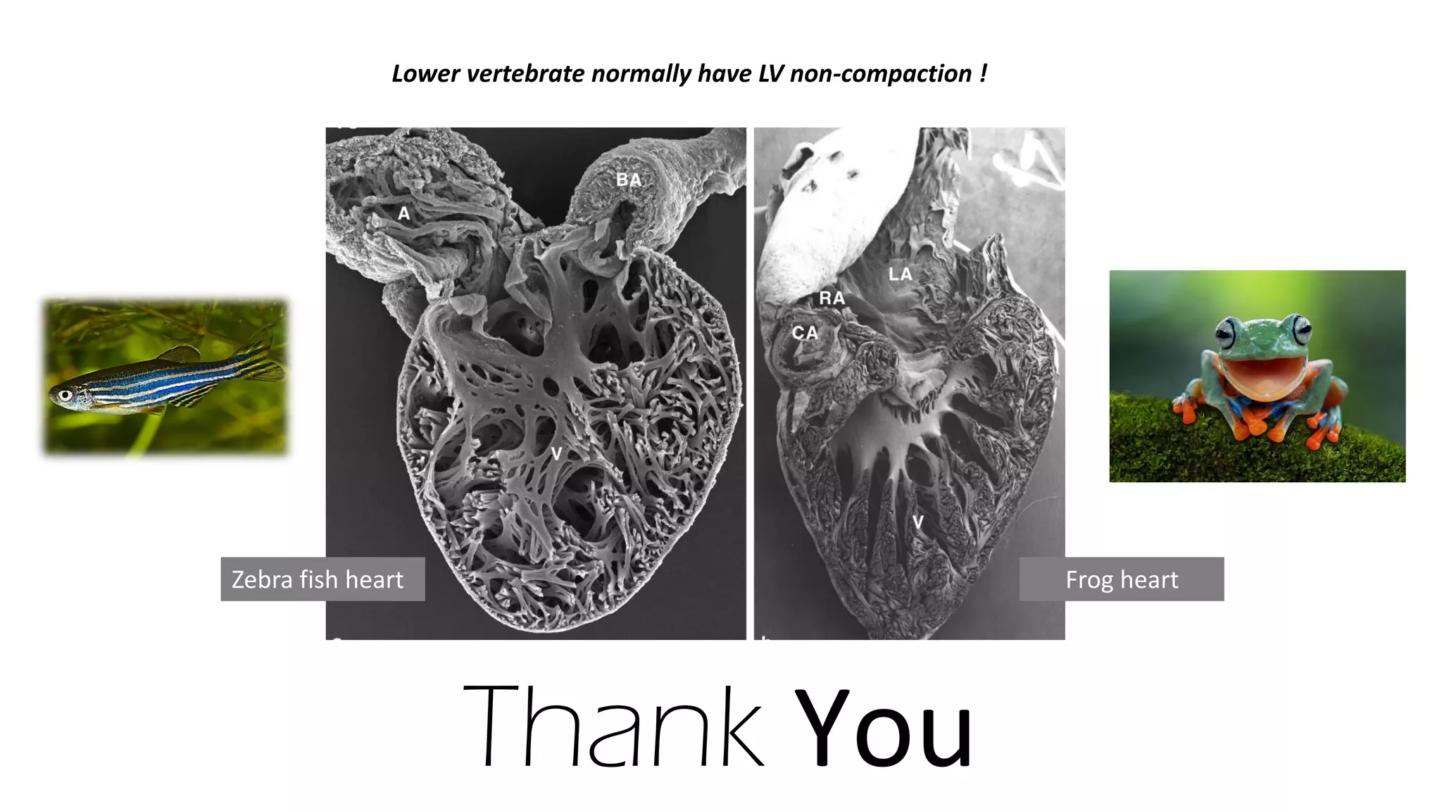 LV non-compaction cardiomyopathy | PDF | Heart and Cardiovascular ...