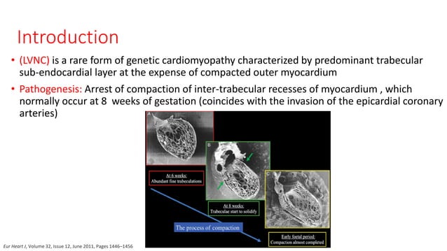 LV non-compaction cardiomyopathy | PDF | Heart and Cardiovascular ...