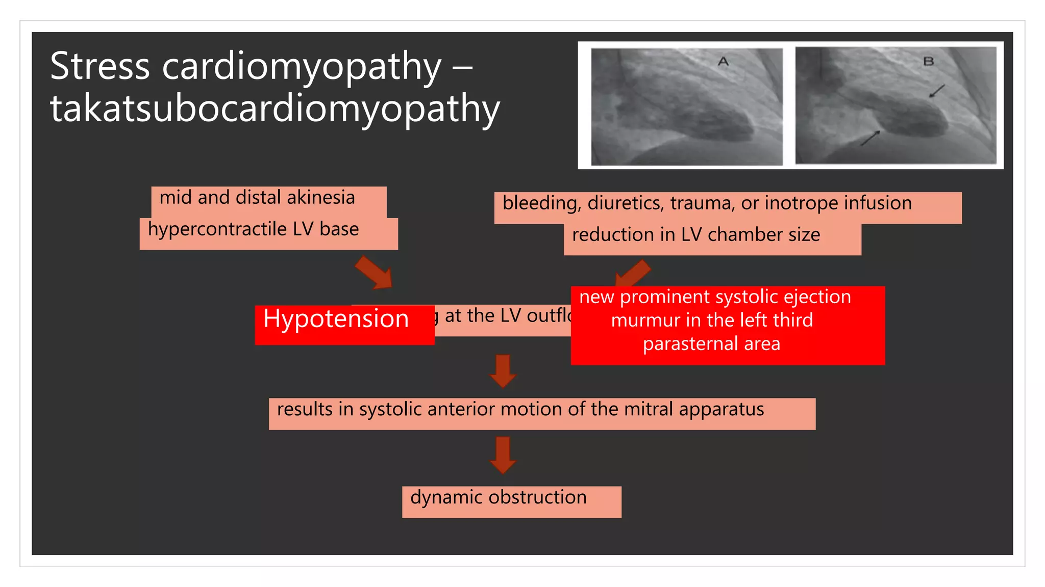 LVOT OBSTRUCTION IN ICU | PPTX