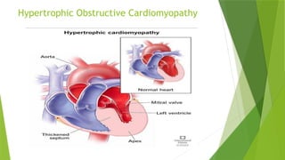 Left ventricular outflow obstruction slide | PPTX