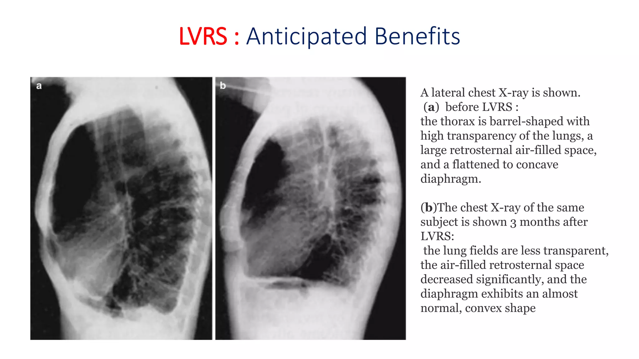 Lung Volume Reduction Surgery | PPTX