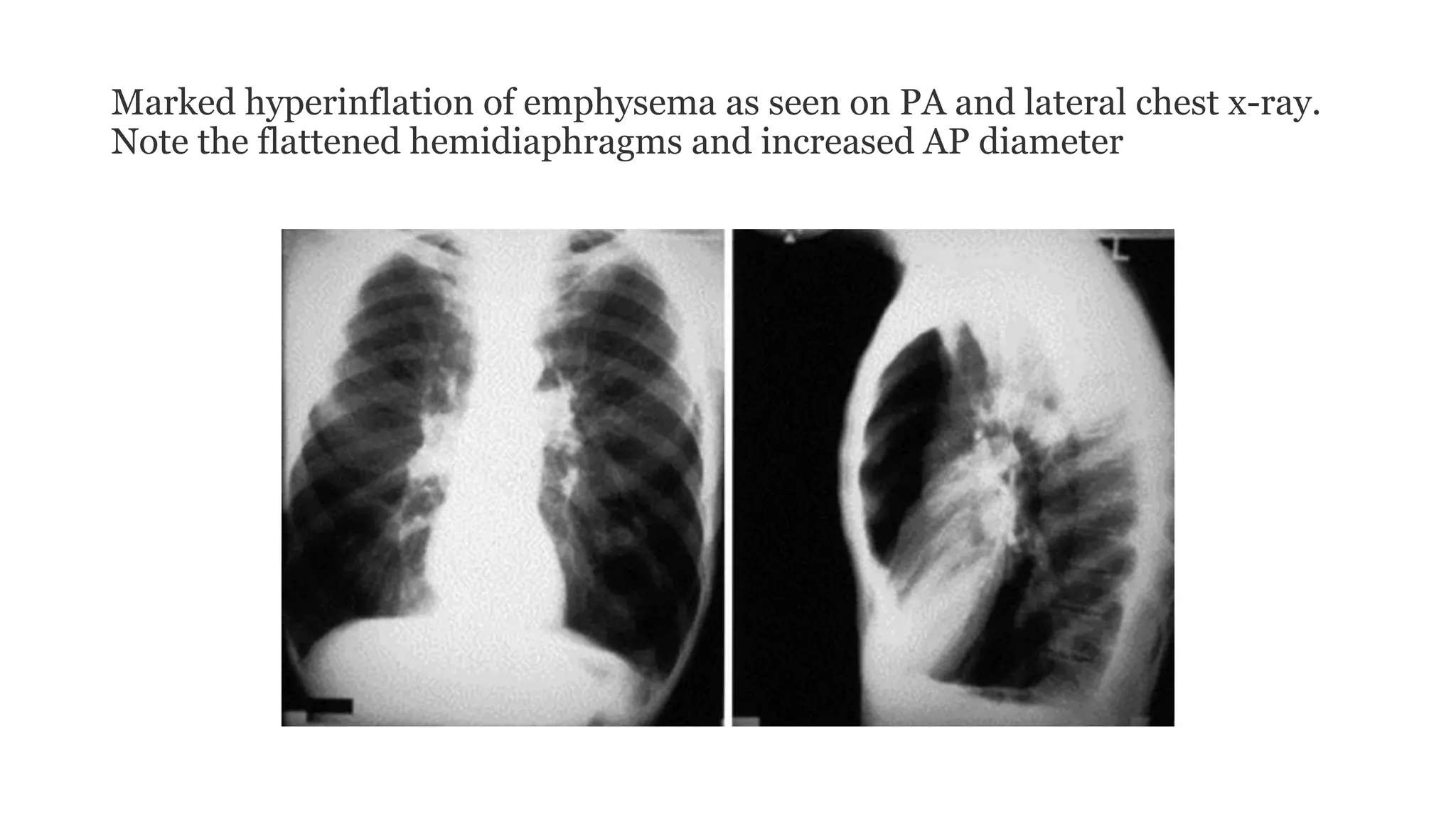 Lung Volume Reduction Surgery | PPTX