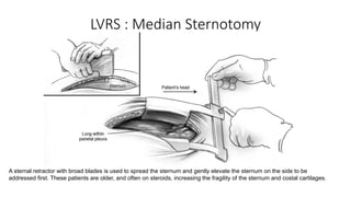Lung Volume Reduction Surgery | PPTX