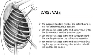 Lung Volume Reduction Surgery | PPTX