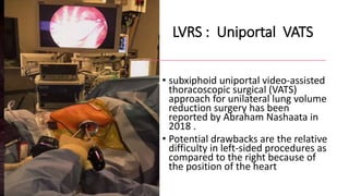 Lung Volume Reduction Surgery | PPTX