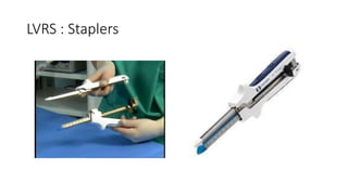 Lung Volume Reduction Surgery | PPTX