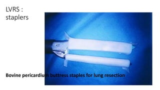 Lung Volume Reduction Surgery | PPTX