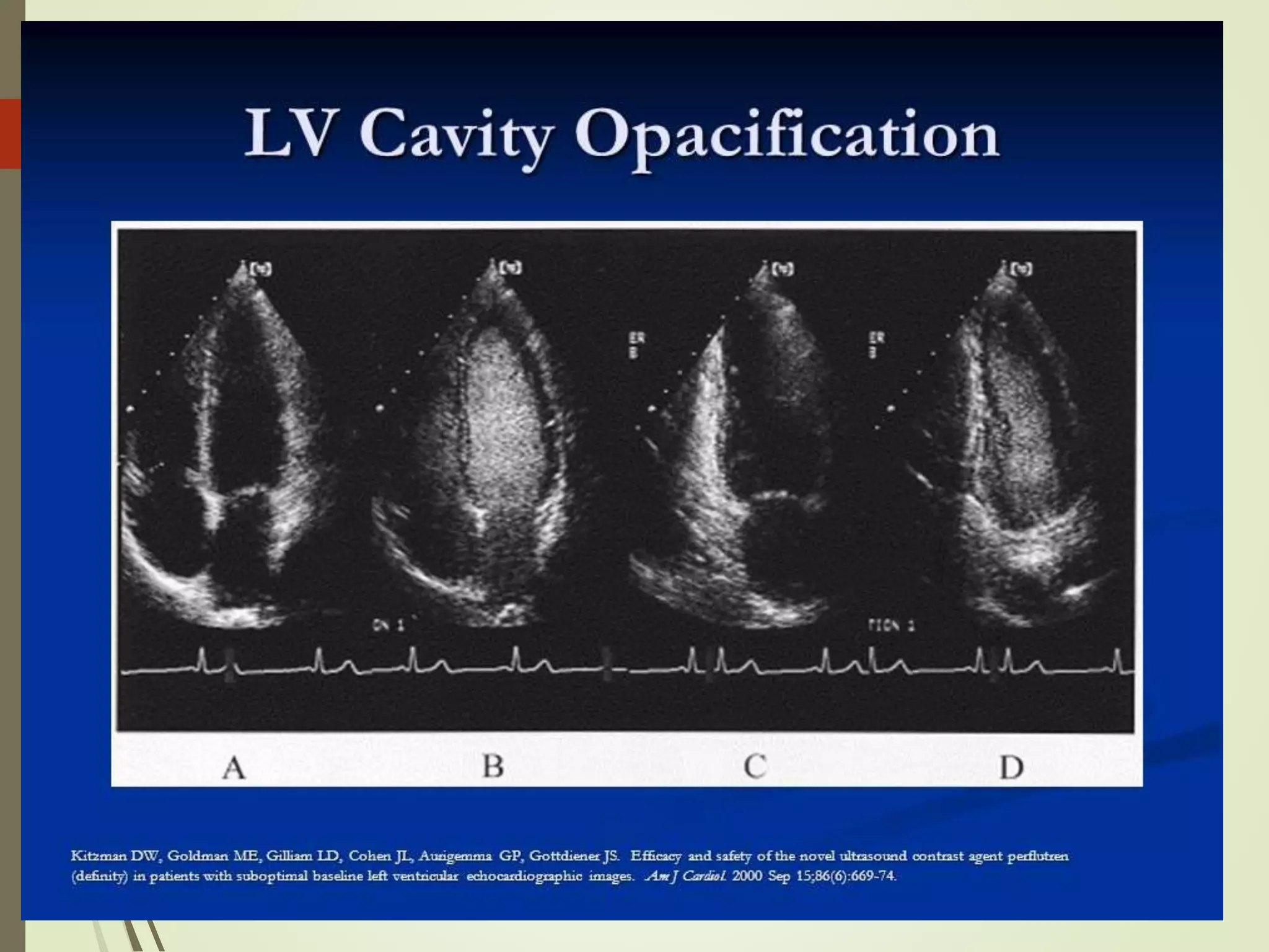 Lv systolic function | PPTX