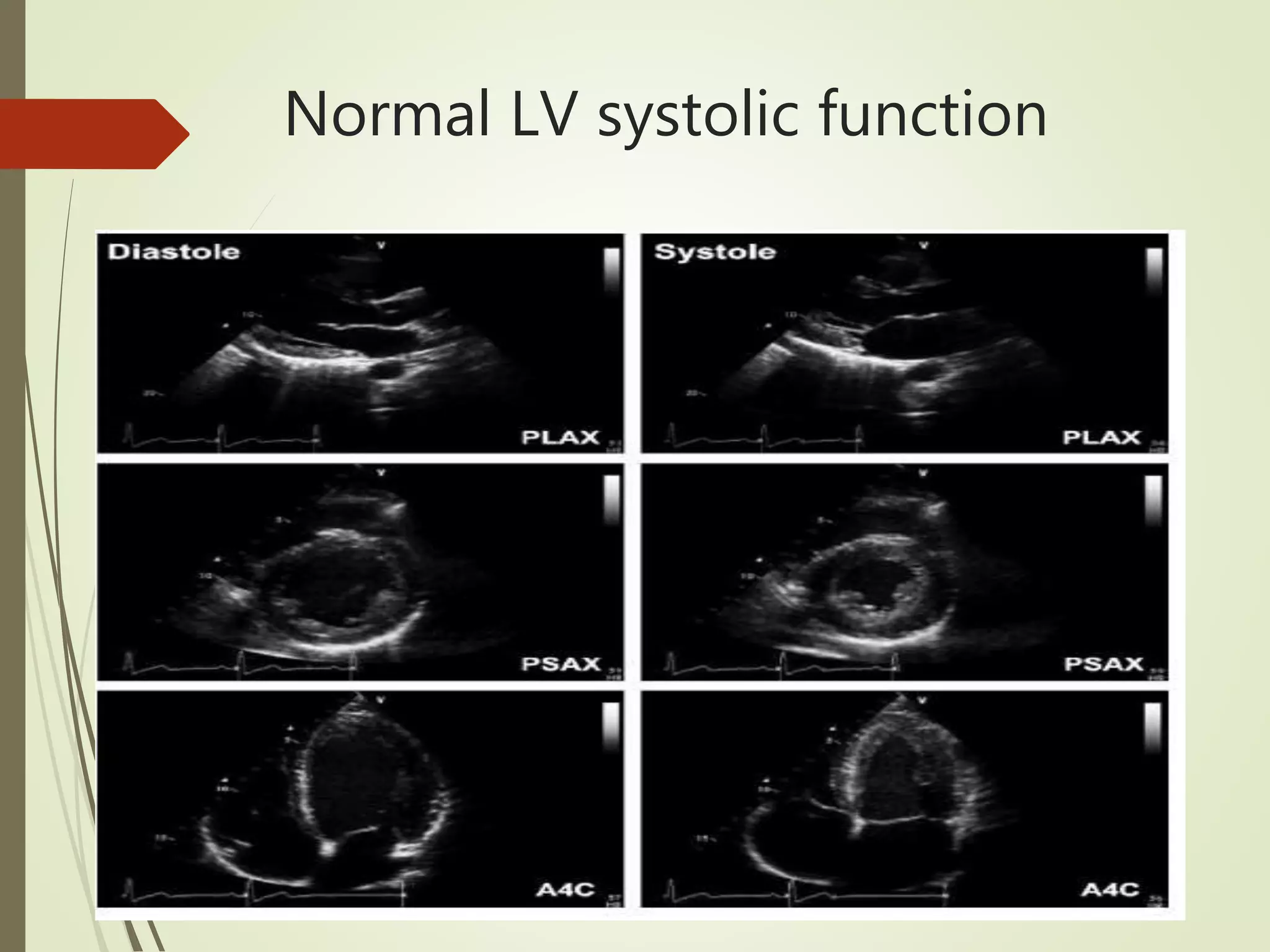 Lv systolic function | PPTX