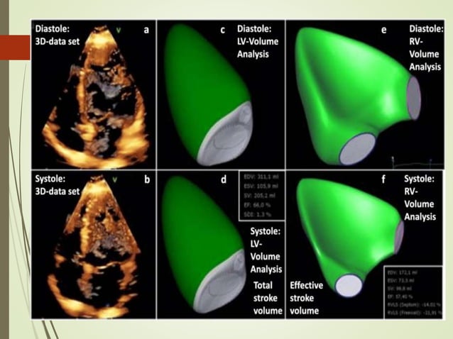 Lv systolic function | PPTX