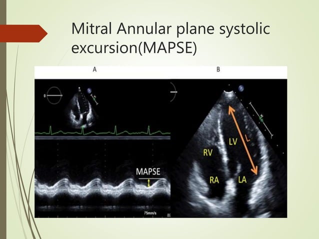 Lv systolic function | PPTX