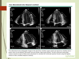 Lv systolic function | PPTX