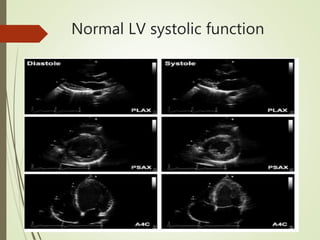Lv systolic function | PPTX