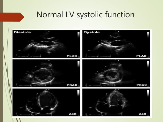 Lv systolic function | PPTX