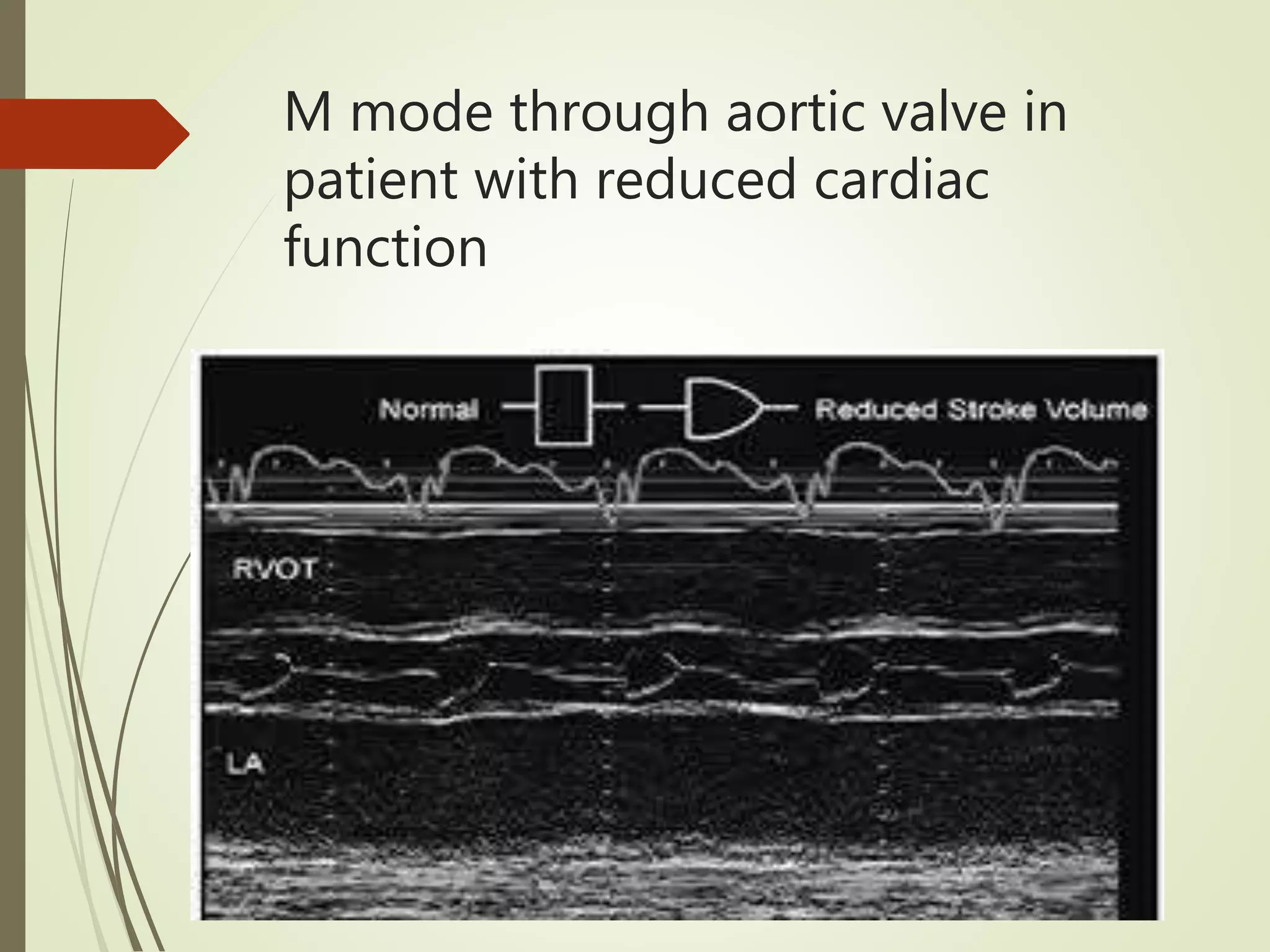 Lv systolic function | PPTX