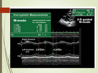Lv systolic function | PPTX