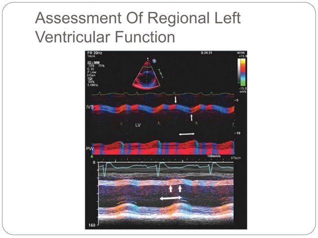 LV Systolic Function.pptx
