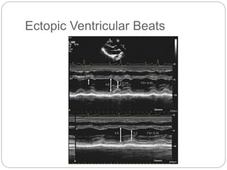 LV Systolic Function.pptx