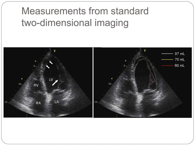 LV Systolic Function.pptx