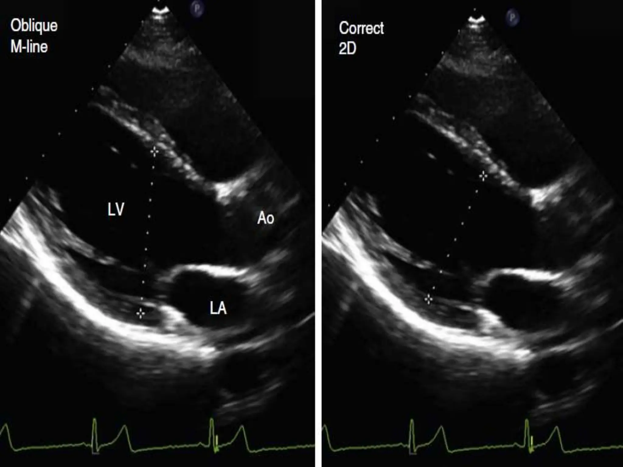 Lv Systolic Functionpptx 3 D Graphics Computer Software And Applications