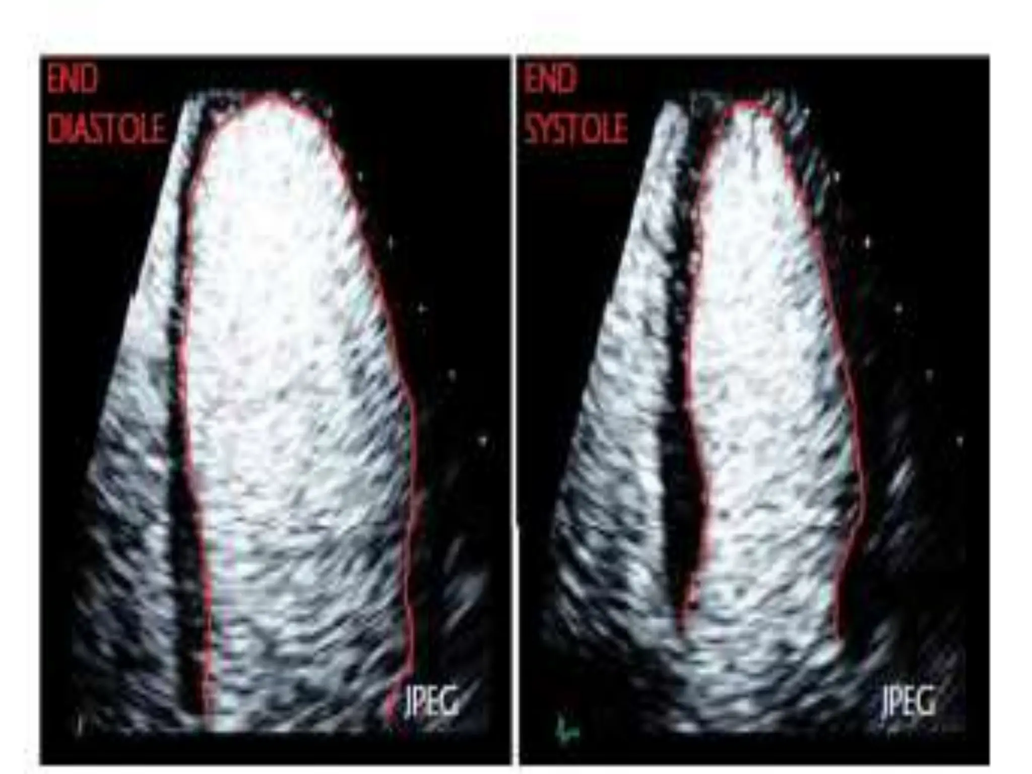 Lv Systolic Function Pptx
