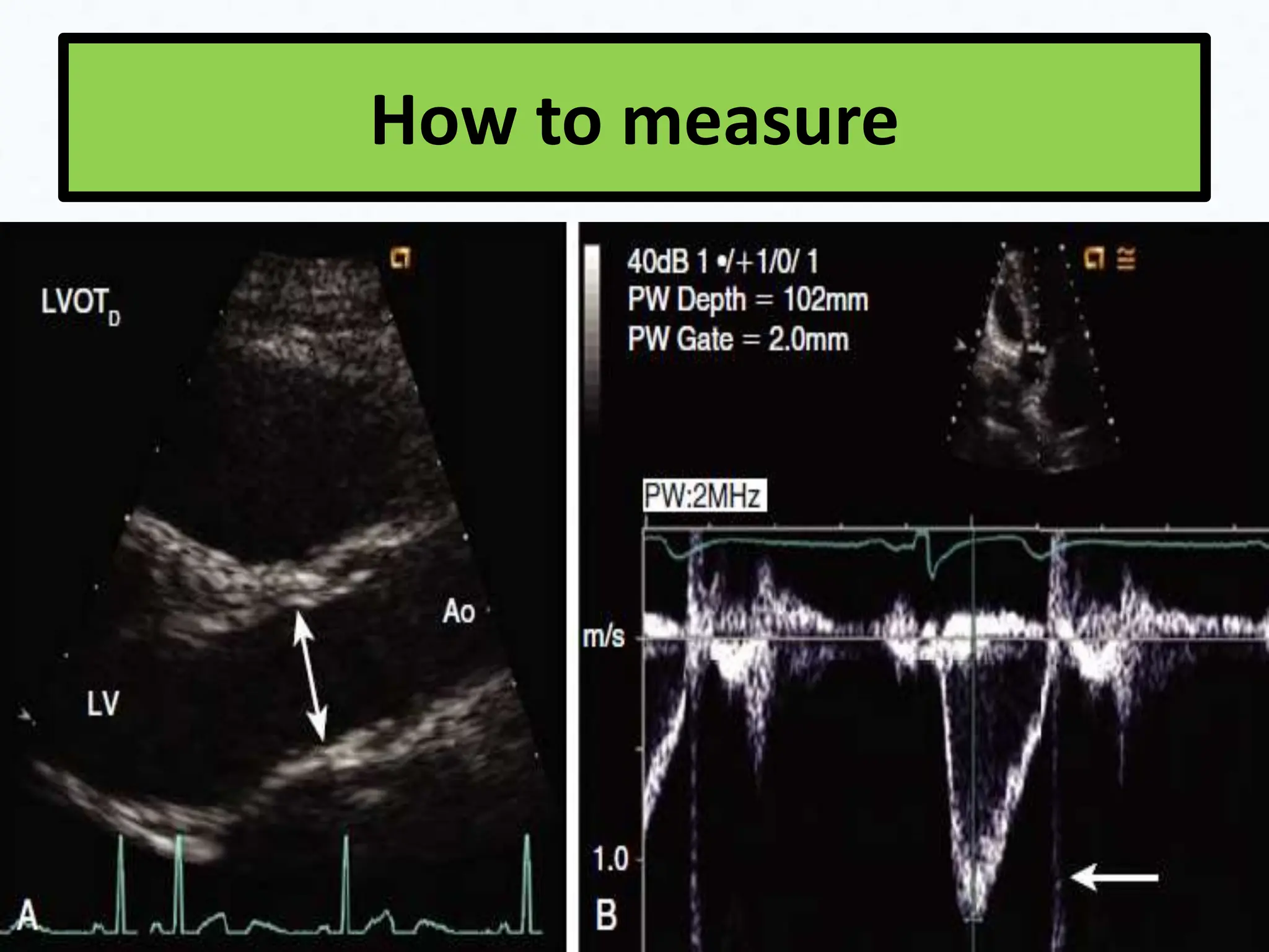 LV systolic function.pptx | 3-D Graphics | Computer Software and ...