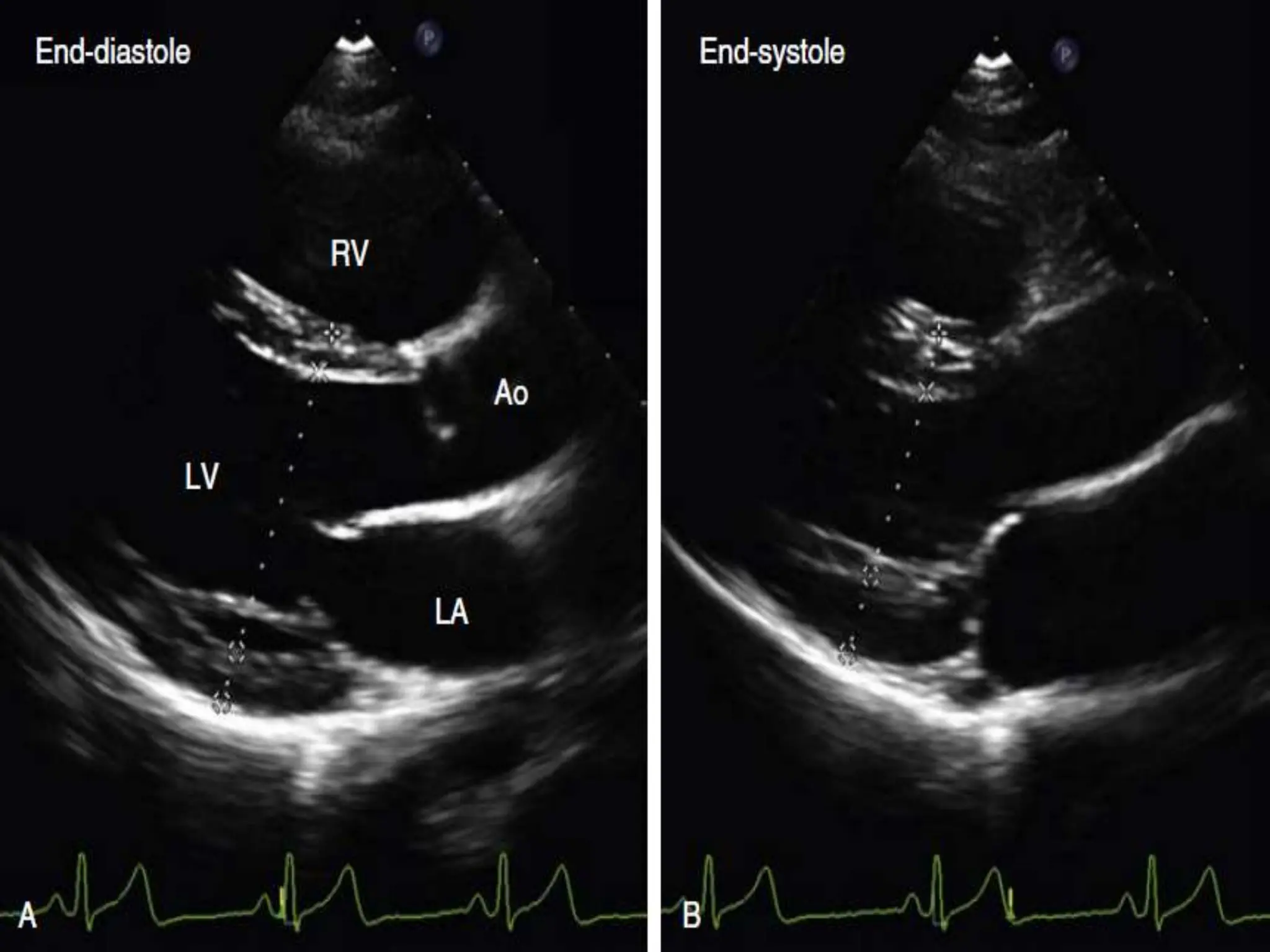 LV systolic function.pptx