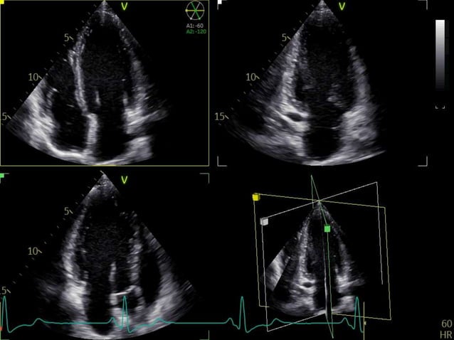 Lv Systolic Function Pptx