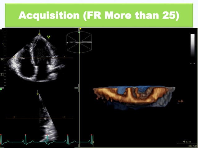 Lv Systolic Function Pptx