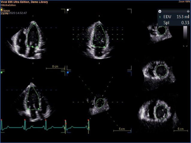 Lv Systolic Function Pptx