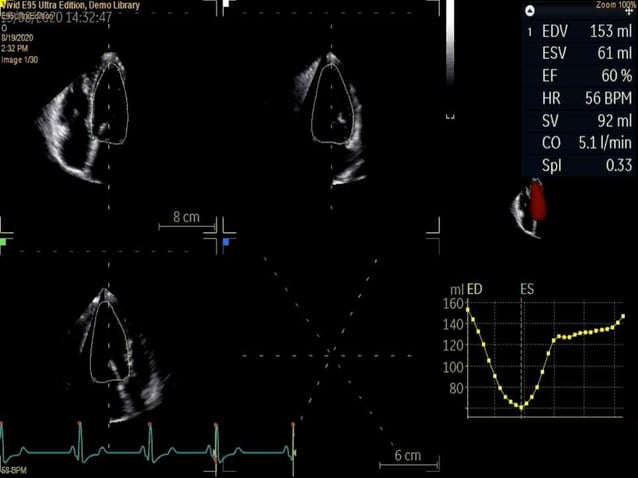 Lv Systolic Function Pptx