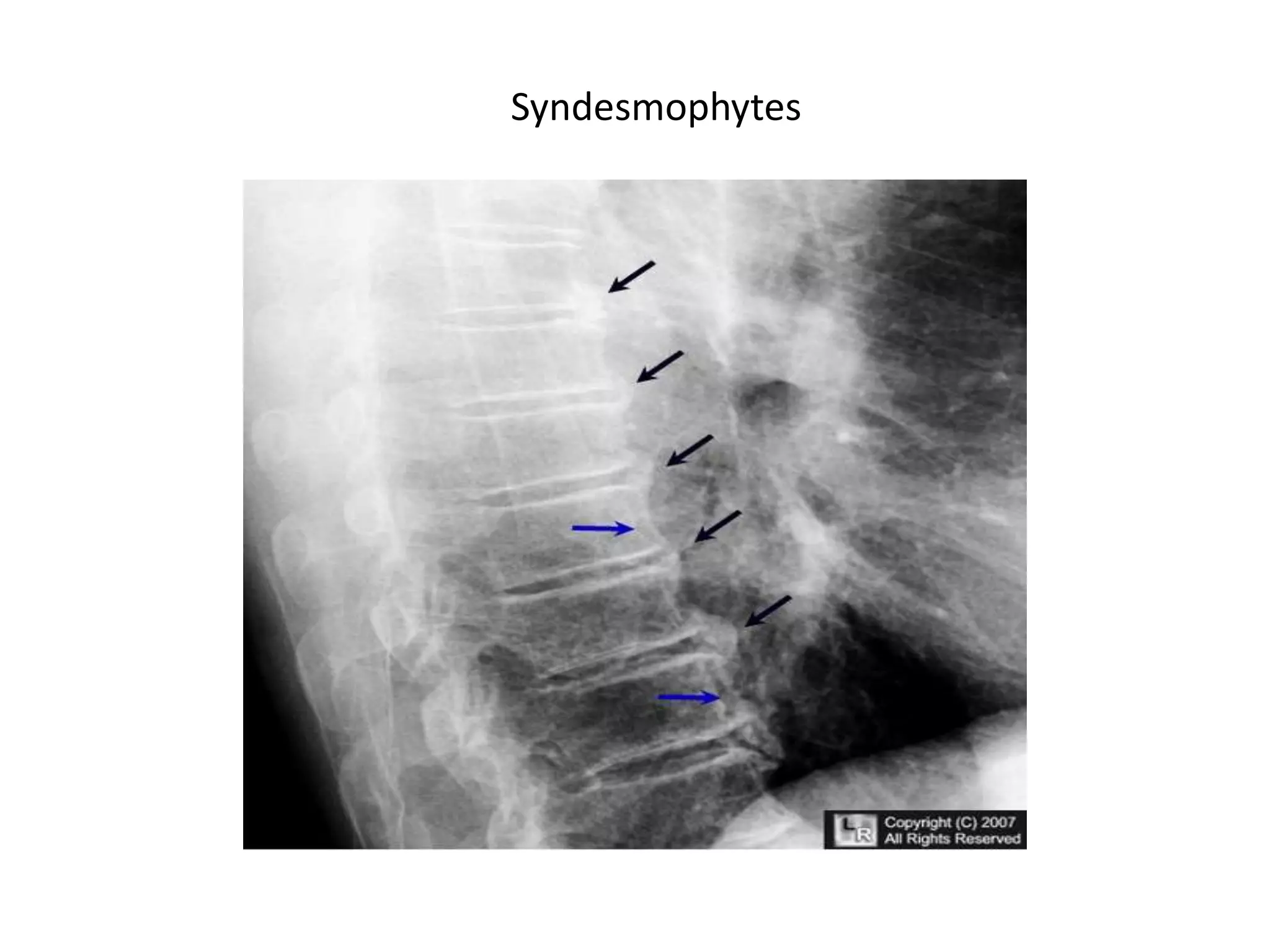 Approach to arthritis | PPTX