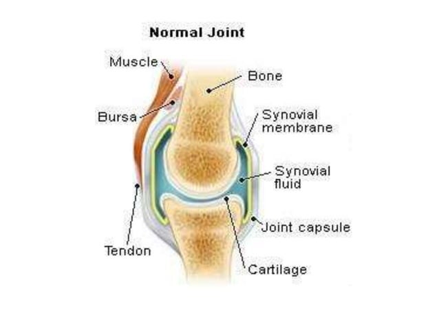 Approach to arthritis | PPTX | Bone and Joint Conditions | Diseases and ...