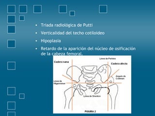 Luxacion congenita de cadera | PPT
