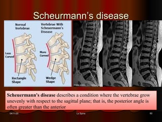 Lumbar Spnine: Anatomy, Biomechanics and Pathomechanics | PDF