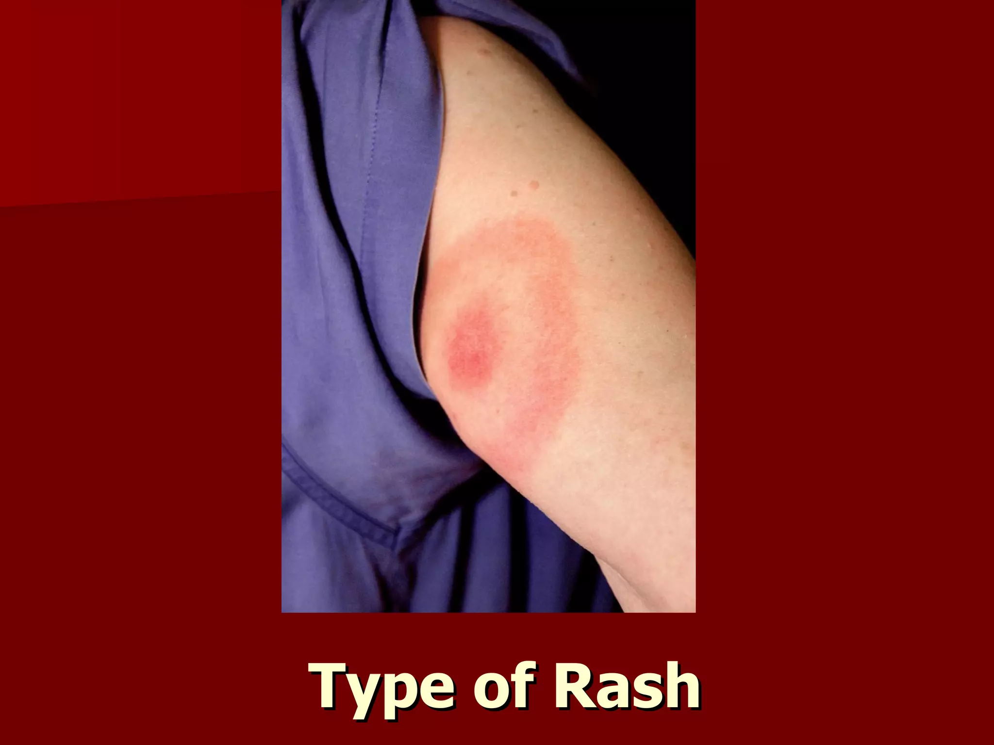 Lyme disease rash | PPT