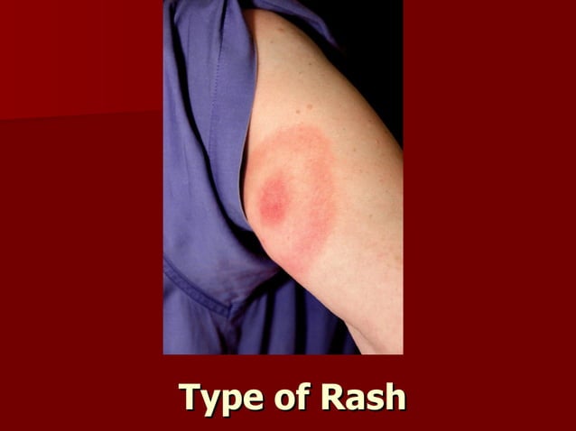 Lyme disease rash | PPT
