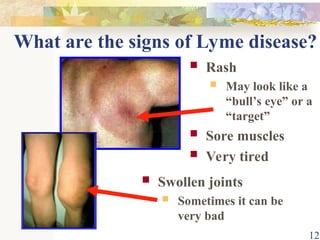 Lyme PPT for Teachers - Lessons on Prevention | PPT