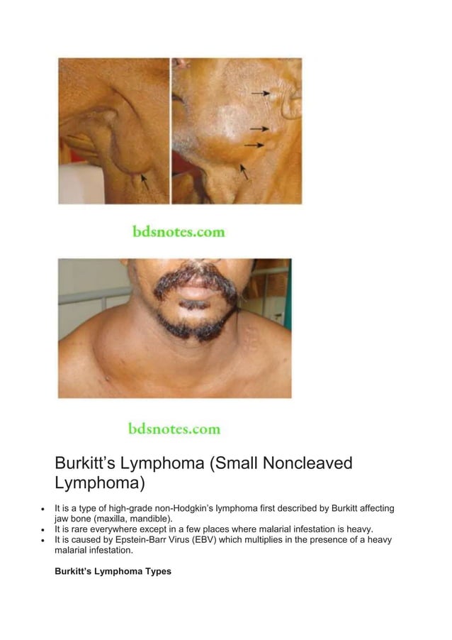 Lymphadenectomy Notes Lymphatics Lymph Vessels And Lymphoma | PDF