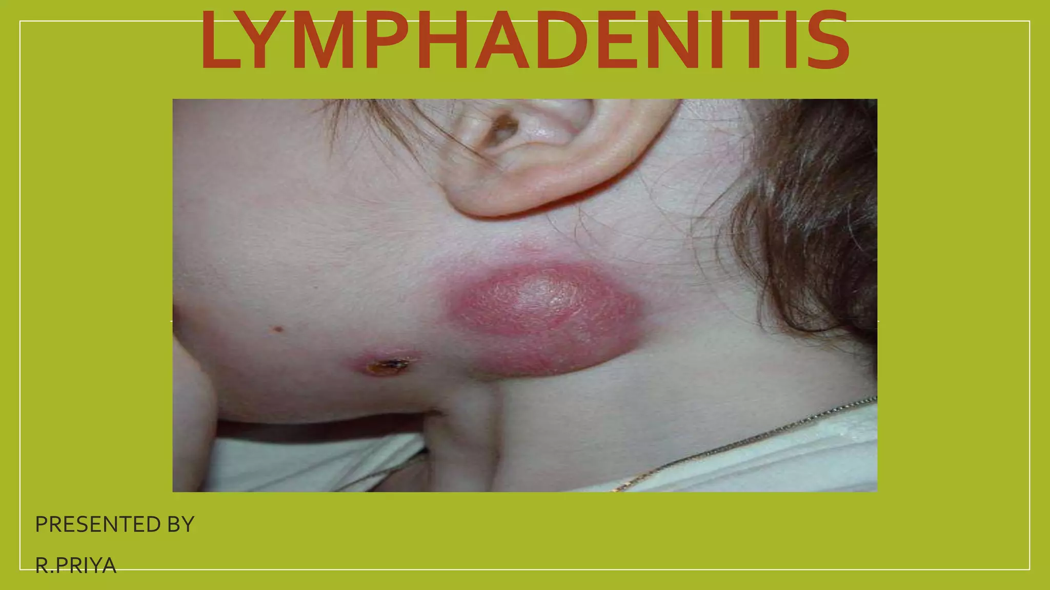 Lymphadenitis | PPTX