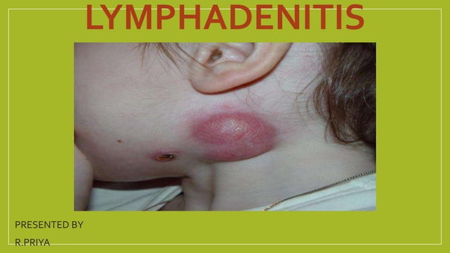 Lymphadenitis | PPT
