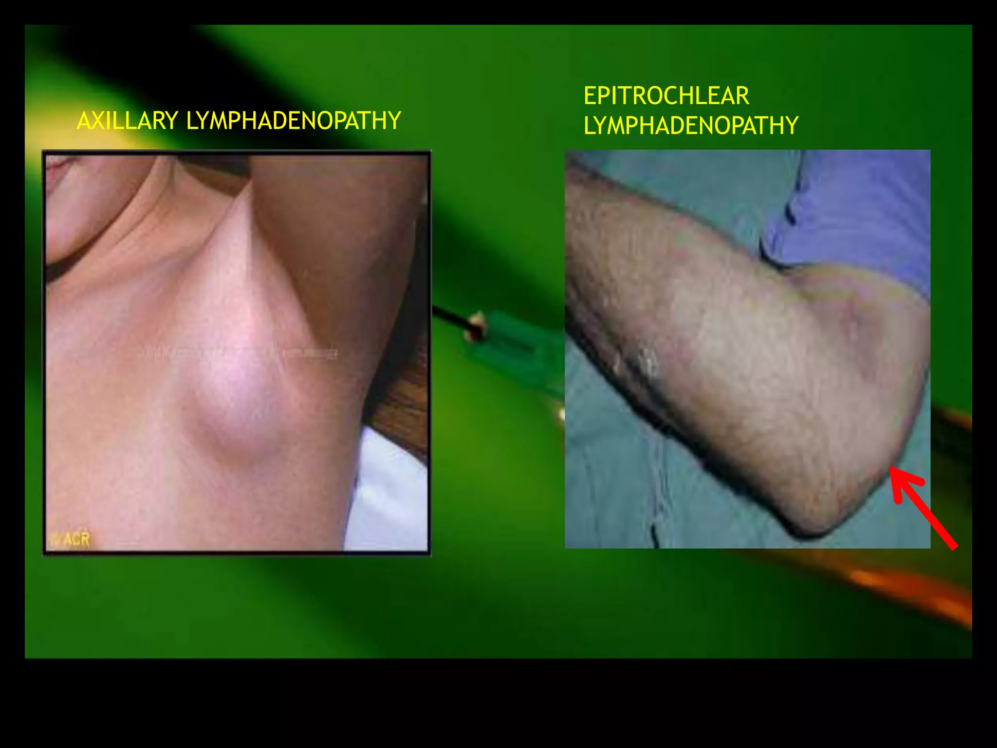 Lymphadenopathy | PPTX