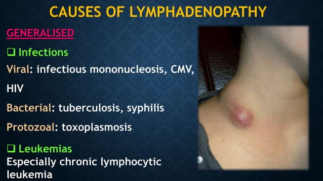 lymphadenopathy.pptx