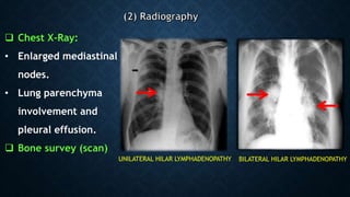 lymphadenopathy.pptx